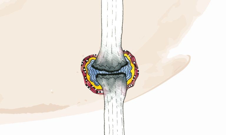 Osteoarthritis (OA) - Joint Colleges Training Services (JCTS)