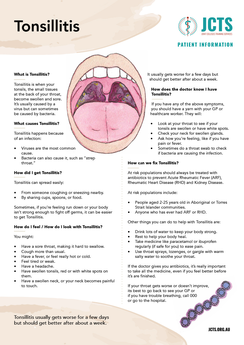 Tonsillitis - Joint Colleges Training Services (JCTS)